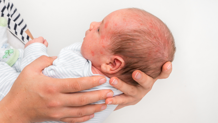 Common Types of Skin Rashes in Babies and Toddlers